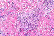 Small vessel leukocytoclastic vasculitis - Libre Pathology