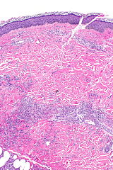 Small vessel leukocytoclastic vasculitis - Libre Pathology