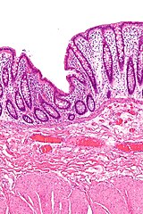 Rectal prolapse - Libre Pathology