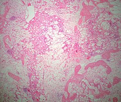 Chordoma - Libre Pathology