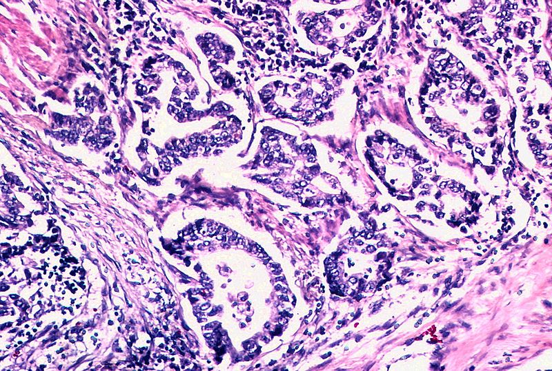 File:Adenocarcinoma, acinar subtype (3923397562).jpg - Libre Pathology