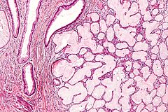 Uterine cervix - Libre Pathology