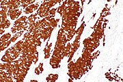 P16 - Libre Pathology