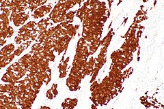 P16 - Libre Pathology