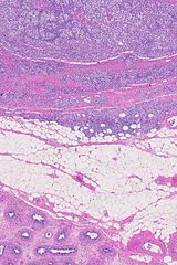 Testicular cancer staging - Libre Pathology
