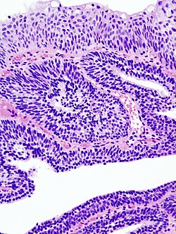Inverted urothelial papilloma - Libre Pathology