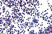 Mesothelial cytopathology - Libre Pathology