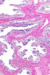 Adenomatous hyperplasia of the rete testis - Libre Pathology