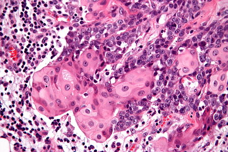 NUT carcinoma - Libre Pathology