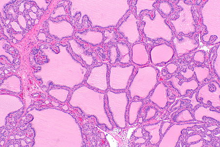 Graves' disease - Libre Pathology