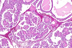 Fumarate hydratase-deficient renal cell carcinoma - Libre Pathology