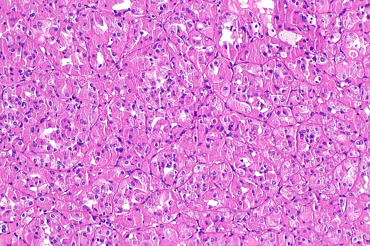 File:Eosinophilic, solid and cystic renal cell carcinoma - solid ...