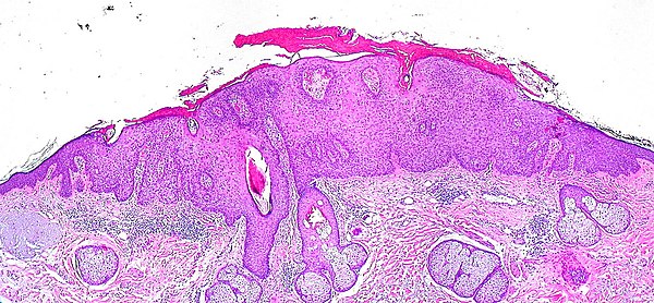 Actinic keratosis - Libre Pathology