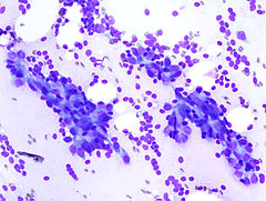 Breast cytopathology - Libre Pathology