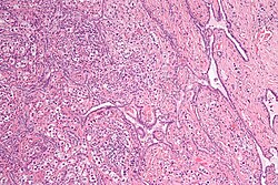 Seminoma - Libre Pathology