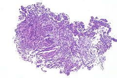 Pulmonary pathology - Libre Pathology