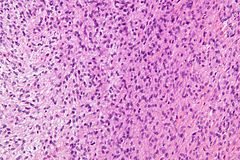 Low-grade fibromyxoid sarcoma - Libre Pathology