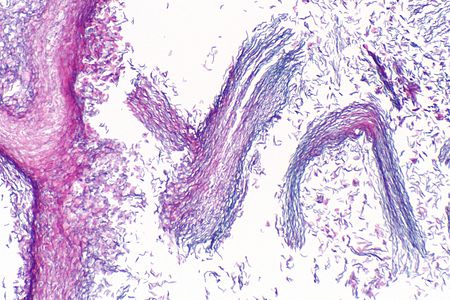 Cholesteatoma - Libre Pathology