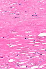 Pleural plaque - Libre Pathology