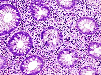Ischemic Colitis Microscopic Pathology