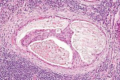 Mucoepidermoid carcinoma - Libre Pathology