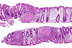 Crohn's disease - Libre Pathology