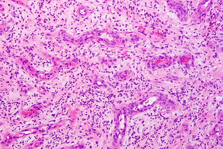 Granulation tissue - Libre Pathology