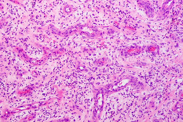 Granulation tissue - Libre Pathology