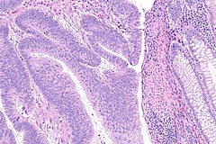 Microsatellite instability in colorectal cancer - Libre Pathology
