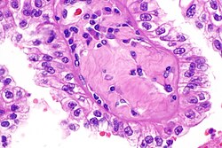 Fumarate hydratase-deficient renal cell carcinoma - Libre Pathology
