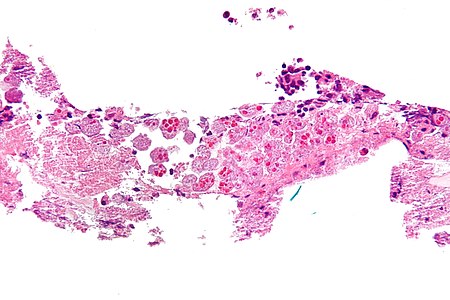 Amebiasis - Libre Pathology