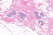 Atypical lobular hyperplasia - Libre Pathology