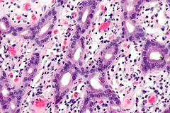 Ampulla of Vater - Libre Pathology