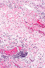 Acute cholecystitis - Libre Pathology
