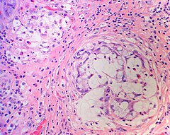 Goblet cell adenocarcinoma - Libre Pathology