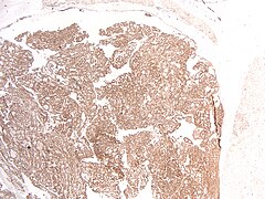Secretory carcinoma of the salivary gland - Libre Pathology