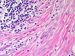Metaplastic breast carcinoma - Libre Pathology