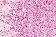 Epithelioid sarcoma - Libre Pathology
