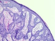 Basal cell carcinoma - Libre Pathology