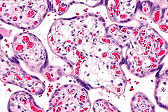 Placental villous immaturity - Libre Pathology