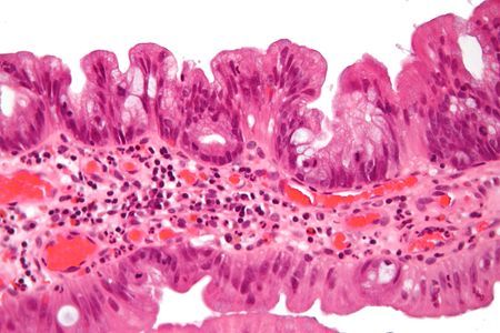 Traditional serrated adenoma - Libre Pathology