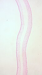 File:Monochorionic Diamniotic Twins, Intervening Membrane.jpg - Libre ...