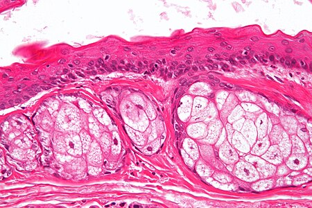 Steatocystoma - Libre Pathology