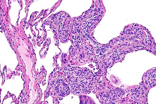 lung cancer histology quiz