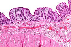 Rectal prolapse - Libre Pathology