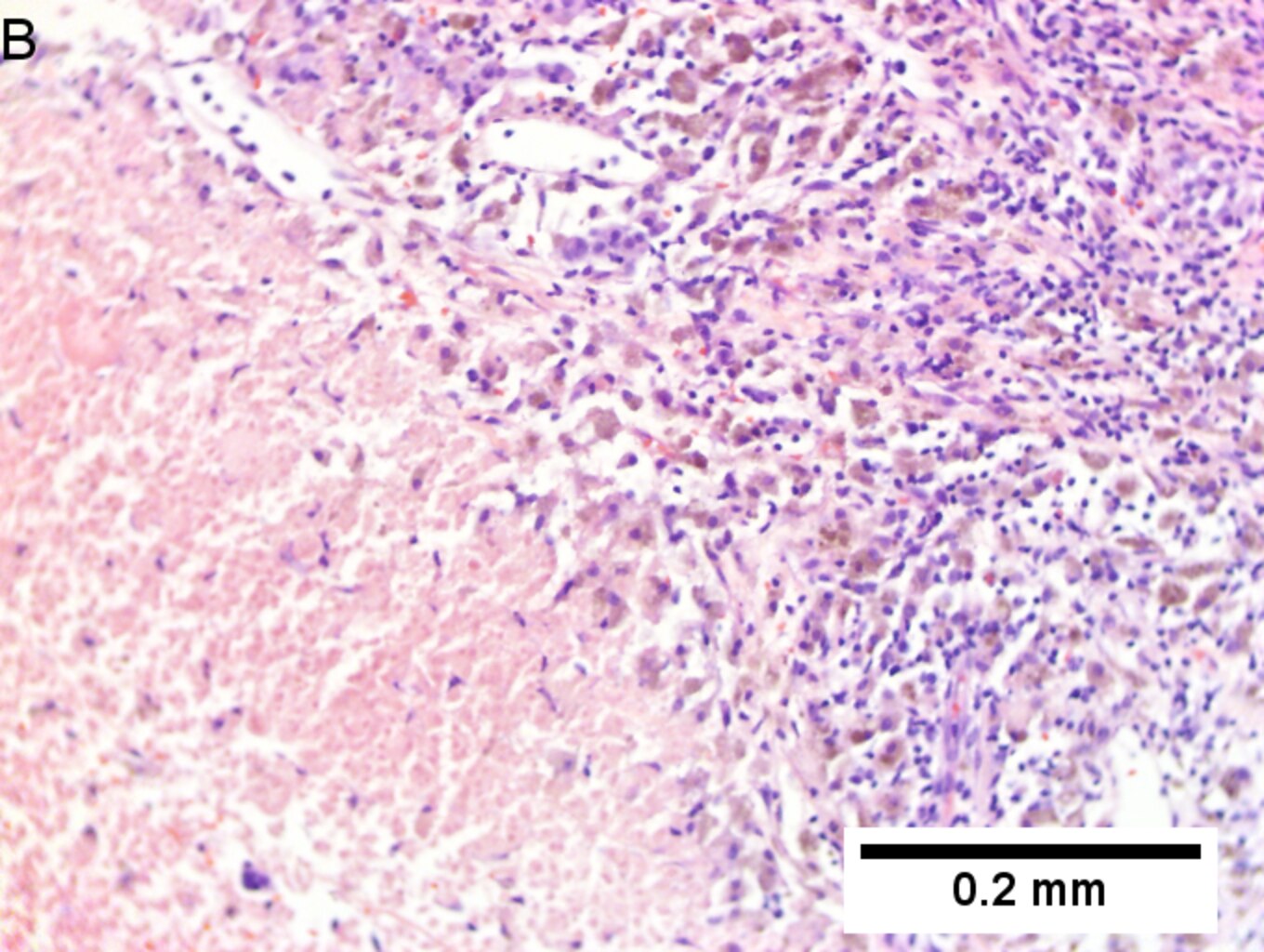 Liver metastasis - Libre Pathology