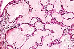 Uterine cervix - Libre Pathology