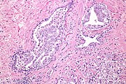 Intraductal carcinoma of the prostate - Libre Pathology