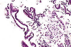 Atrophic endometrium - Libre Pathology