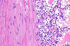 ELOC-mutated renal cell carcinoma - Libre Pathology
